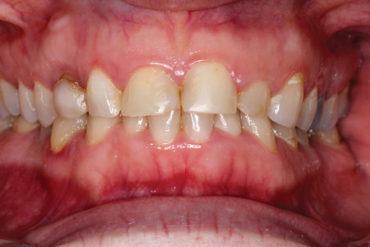 Transitional Bonding for the Severely Eroded Dentition - Oral Health Group
