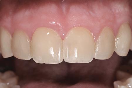 Bioactive Giomer Materials Can Help Improve Clinical Outcomes - Oral ...