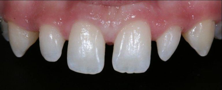 Bioactive Giomer Materials Can Help Improve Clinical Outcomes - Oral ...