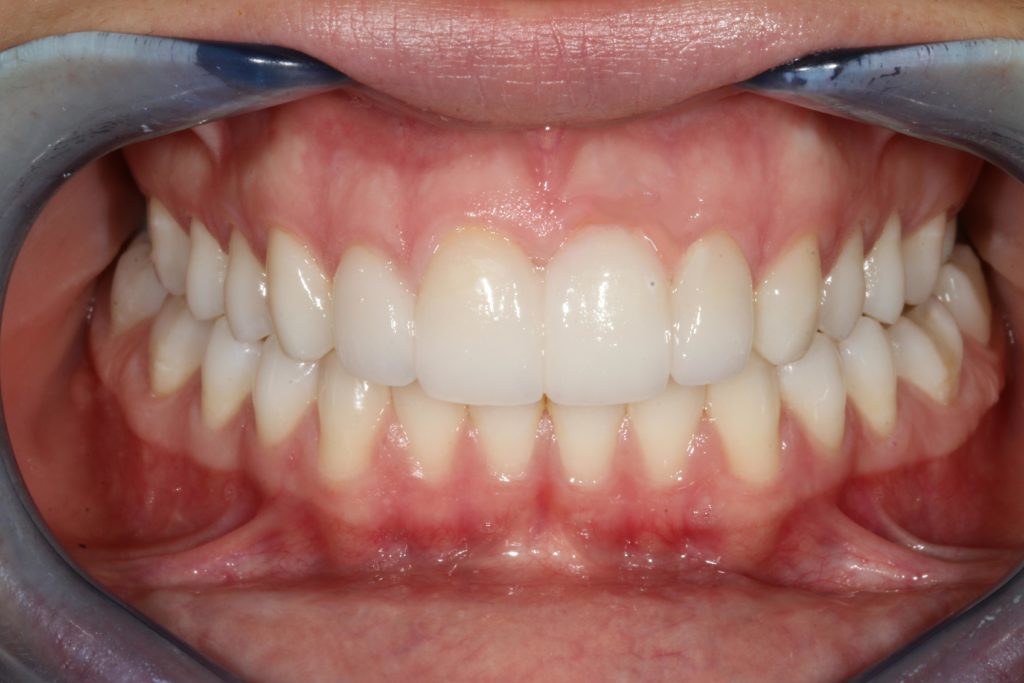 Bioactive Giomer Materials Can Help Improve Clinical Outcomes - Oral ...