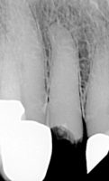 Cutting Endodontic Access Cavities for Long-Term Outcomes