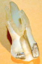 Cutting Endodontic Access Cavities for Long-Term Outcomes