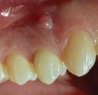 Root Canal Treatment of Maxillary Premolars With Three Roots