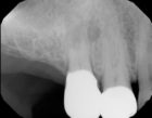 Root Canal Treatment of Maxillary Premolars With Three Roots