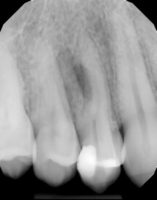 Root Canal Treatment of Maxillary Premolars With Three Roots