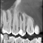 Root Canal Treatment of Maxillary Premolars With Three Roots
