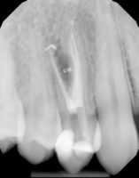 Root Canal Treatment of Maxillary Premolars With Three Roots