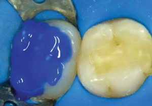 Simplifying the Adhesive and Composite Placement Protocol for Direct ...