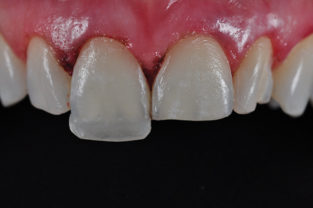 Case Report: The Margin Perfect Matrix – A Predictable Technique for the Fabrication of Direct ...