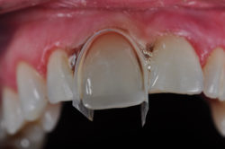Case Report: The Margin Perfect Matrix – A Predictable Technique for the Fabrication of Direct ...
