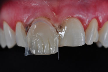 Case Report: The Margin Perfect Matrix – A Predictable Technique for ...