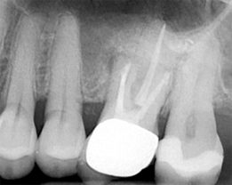 The Cortical Window: Part Two Computer Guided Endodontic Surgery (CGES)