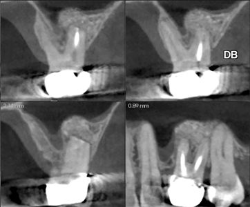The Cortical Window: Part Two Computer Guided Endodontic Surgery (CGES)