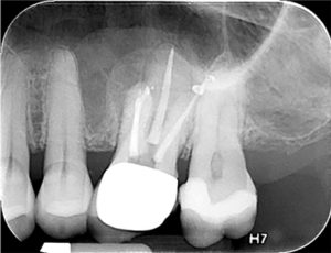 The Cortical Window: Part Two Computer Guided Endodontic Surgery (CGES)