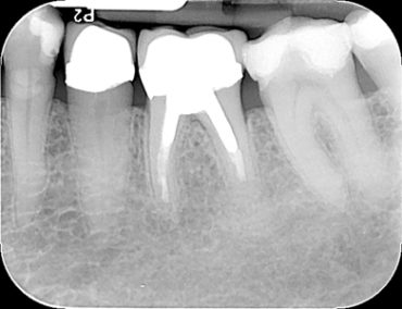 The Cortical Window: Part One The Evolution of Endodontic Surgery