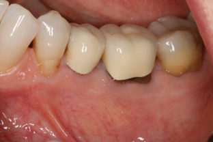 The Cortical Window: Part One The Evolution of Endodontic Surgery