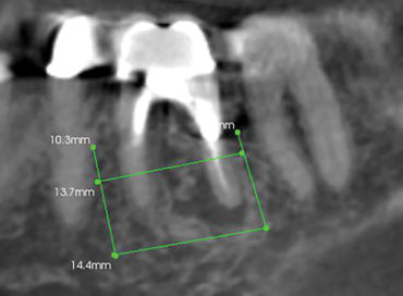The Cortical Window: Part One The Evolution of Endodontic Surgery