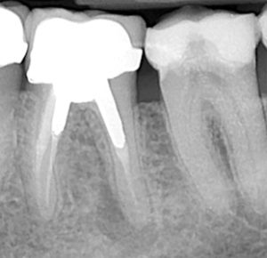 The Cortical Window: Part One The Evolution of Endodontic Surgery