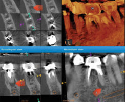 The Cortical Window: Part One The Evolution of Endodontic Surgery