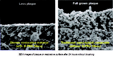 Bioactive Giomer Materials Can Help Improve Clinical Outcomes - Oral ...