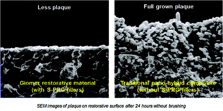 Bioactive Giomer Materials Can Help Improve Clinical Outcomes - Oral ...