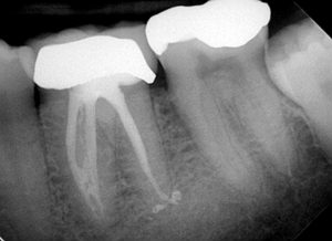 Product Profile: GentleWave® System - Oral Health Group