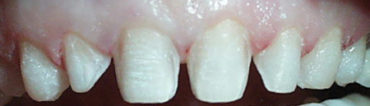 Veneer Temporization: A Simple Approach to Healthy Results