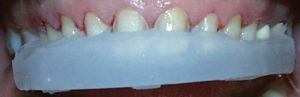 Veneer Temporization: A Simple Approach to Healthy Results
