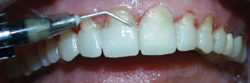 Veneer Temporization: A Simple Approach to Healthy Results