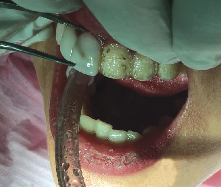 A Novel Approach to Veneer Removal: A Clinical Case Report Using Er,Cr ...