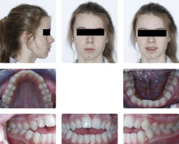 Predictable Open Bite Correction - Oral Health Group