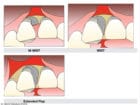 Improved Long-Term Treatment Outcomes of Teeth with Deep Pockets and ...