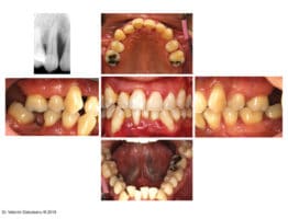 Improved Long-Term Treatment Outcomes of Teeth with Deep Pockets and ...
