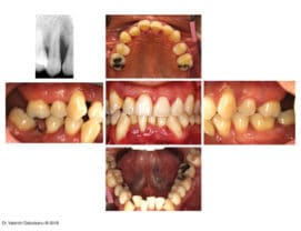 Improved Long-Term Treatment Outcomes of Teeth with Deep Pockets and ...