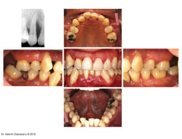 Improved Long-Term Treatment Outcomes of Teeth with Deep Pockets and ...
