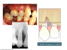 Improved Long-Term Treatment Outcomes of Teeth with Deep Pockets and ...