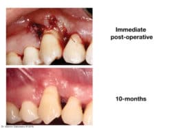 Improved Long-Term Treatment Outcomes of Teeth with Deep Pockets and ...