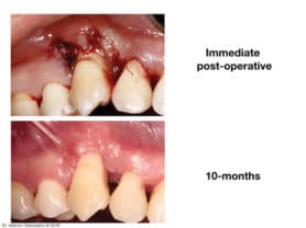 Improved Long-Term Treatment Outcomes of Teeth with Deep Pockets and ...