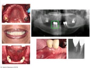Improved Long-Term Treatment Outcomes of Teeth with Deep Pockets and ...