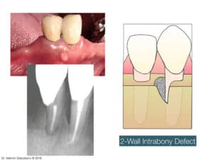 Improved Long-Term Treatment Outcomes of Teeth with Deep Pockets and ...