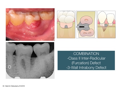 Improved Long-Term Treatment Outcomes of Teeth with Deep Pockets and ...