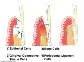 Improved Long-Term Treatment Outcomes of Teeth with Deep Pockets and ...
