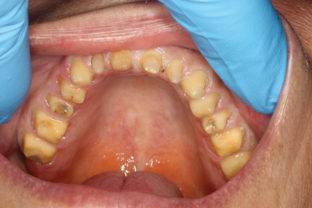 Tissue Management: A Guide to Capture a Single Tooth Preparation up to ...