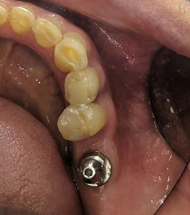 Immediate Implant: A Case Report - Oral Health Group