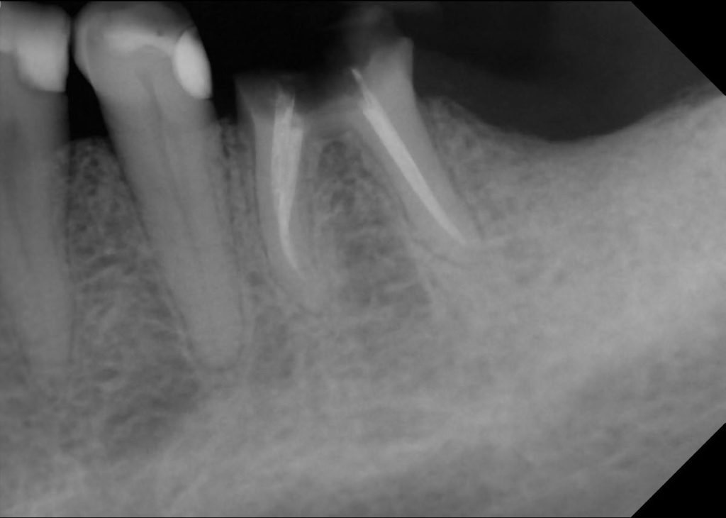 Fig 2 - #36 endodontically treated with debonded crown. Note the flare ...