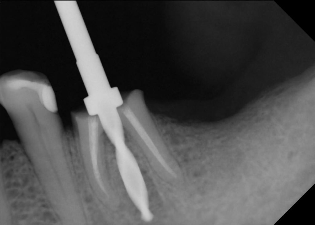 Fig 4 - Radiographic verification of the 2.2 twist drill in the furca ...