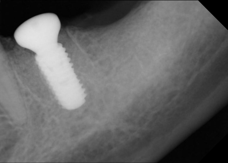 Immediate Implant: A Case Report - Oral Health Group