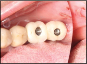 Retrieval Of Damaged Prosthetic Screws: A Case Series Of Techniques