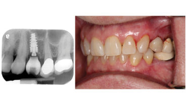 Prosthetically Driven Implant Surgery: Redefined - Oral Health Group