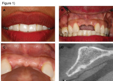 The Intra-Oral Mandibular Ramus Block Autograft: Still a Relevant ...